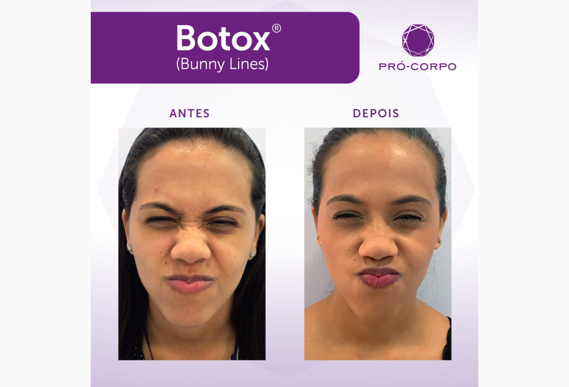 Botox ® Light | Loja Pró-Corpo Estética Avançada