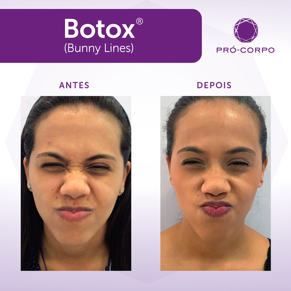 Botox ® Light | Loja Pró-Corpo Estética Avançada